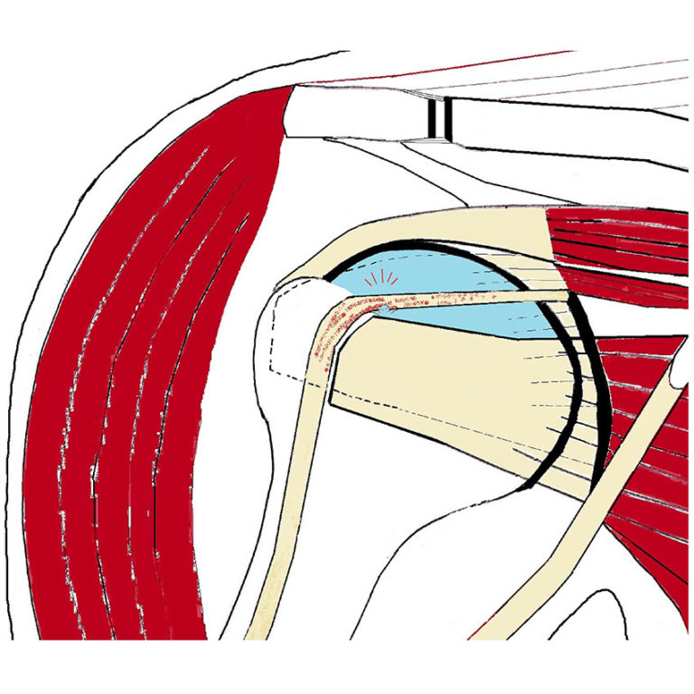 Traitement de la tendinite du biceps de l’épaule à Versailles ...