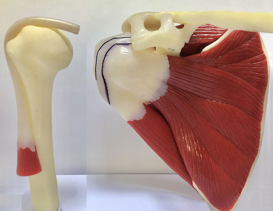 Traitement de la tendinite du biceps de l’épaule à Versailles ...